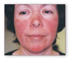 Dile adios a la Rosacea: OTROS TRATAMIENTOS PARA LA ROSÁCEA