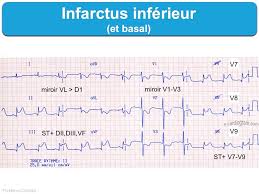 英和画像辞典：(infarctus)の関連画像一覧！
